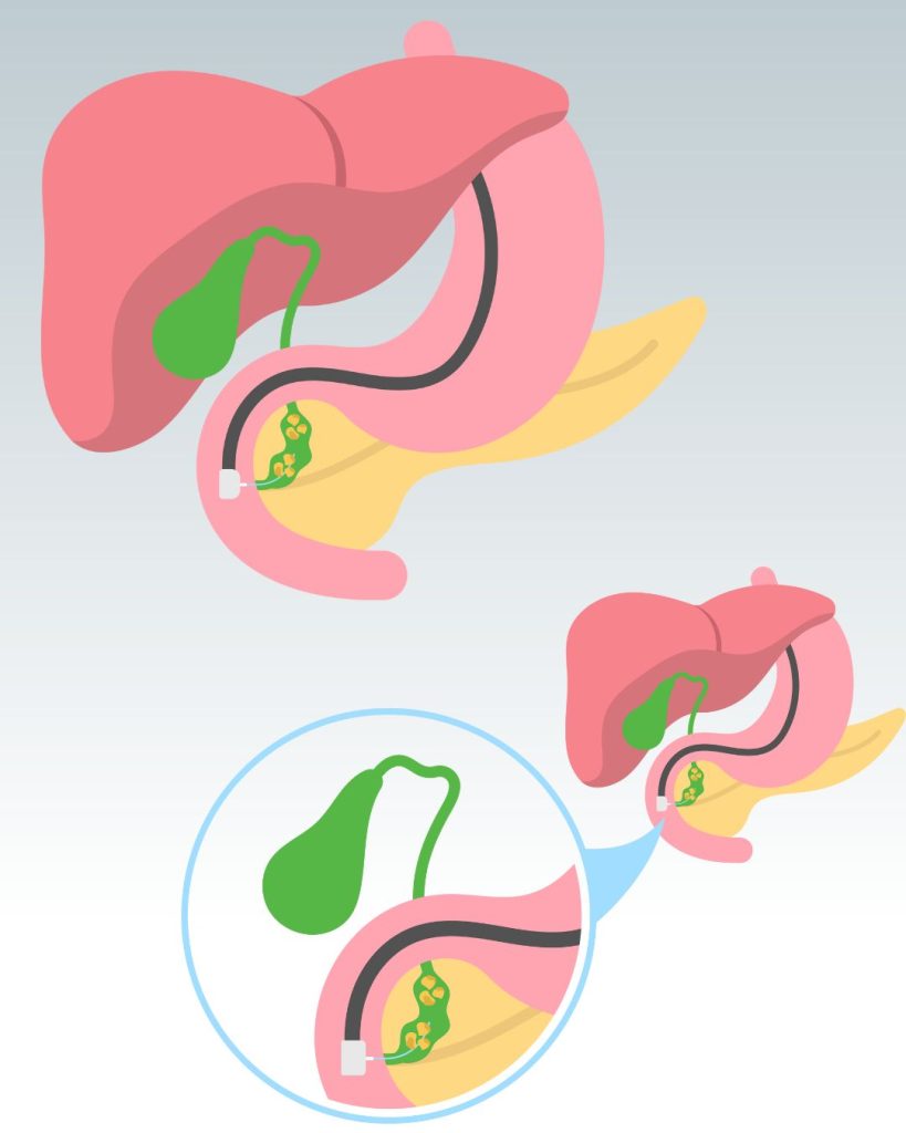 Best ERCP Hospital In Rewari | ERCP Treatment Surgery