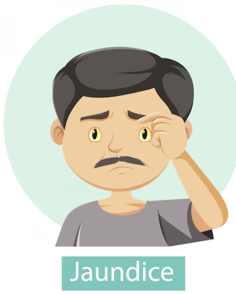 Jaundice - Dr. Neel Kamal