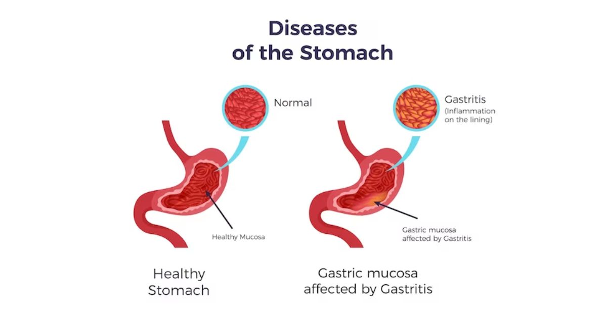 Gastric Cancer - Dr. Neel Kamal